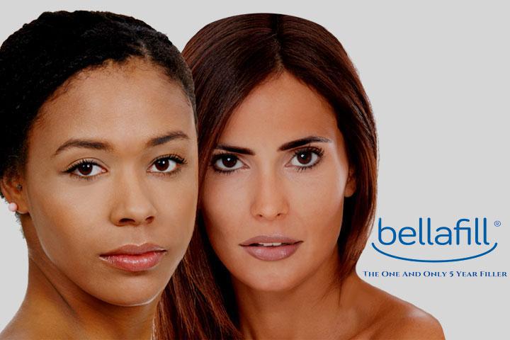 Bellafill - Longest Lasting Smile Line Filler | Zinnia Aesthetics and ...