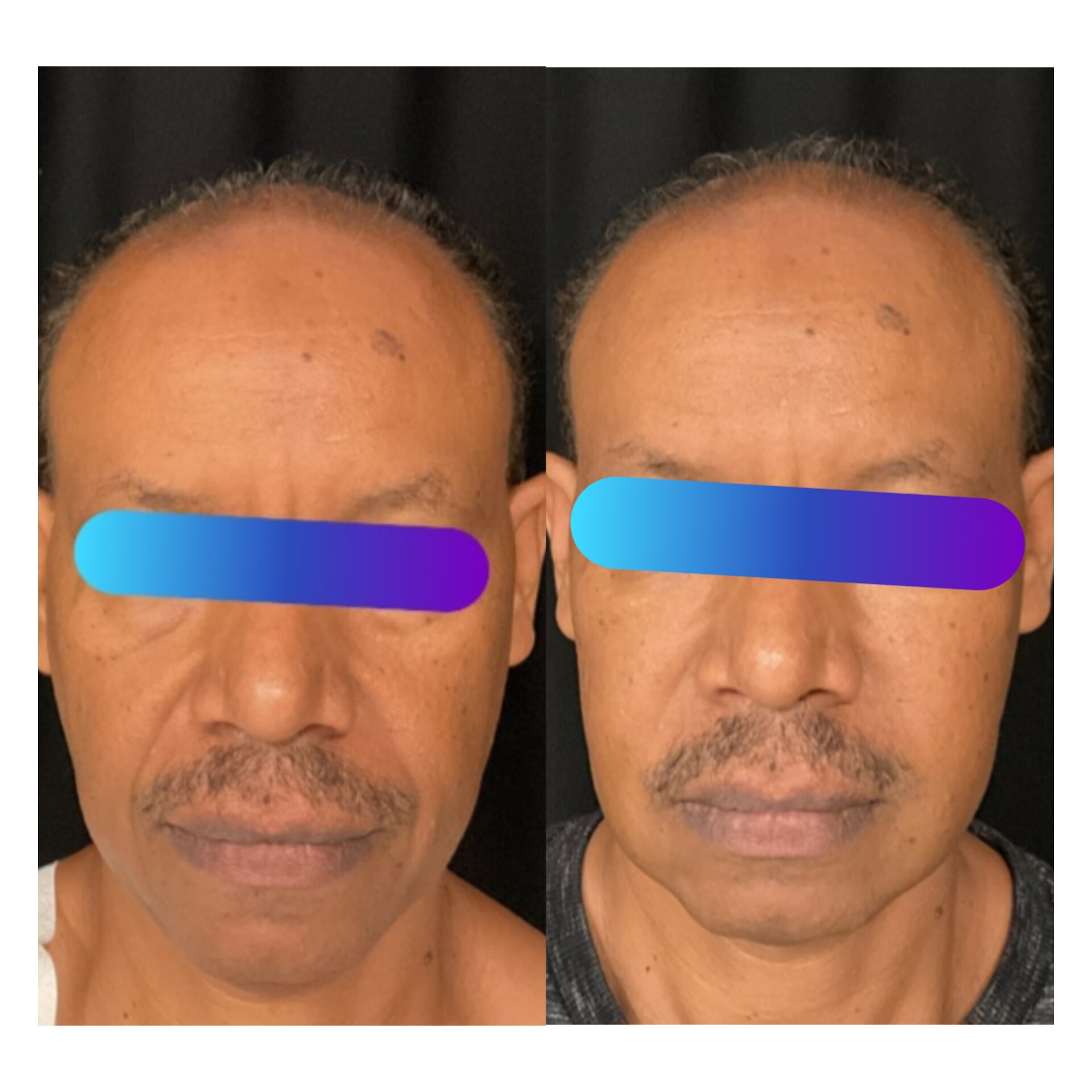 DMV Fat Transfer to Face | Zinnia Aesthetics and Anti-Aging Clinic